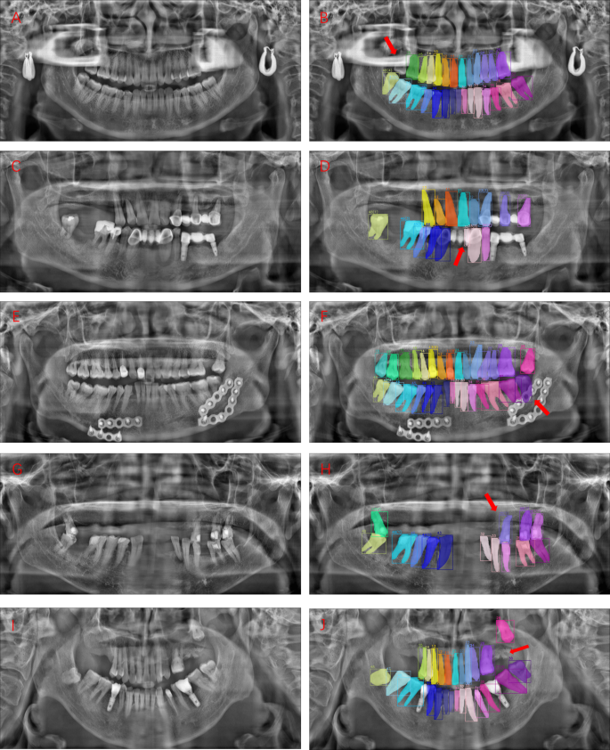 A dual-labeled dataset and fusion model for automatic teeth segmentation, numbering, and state ...