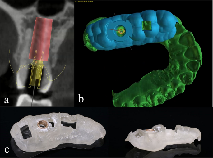 Peri-implant soft tissue conditioning of immediate posterior implants ...