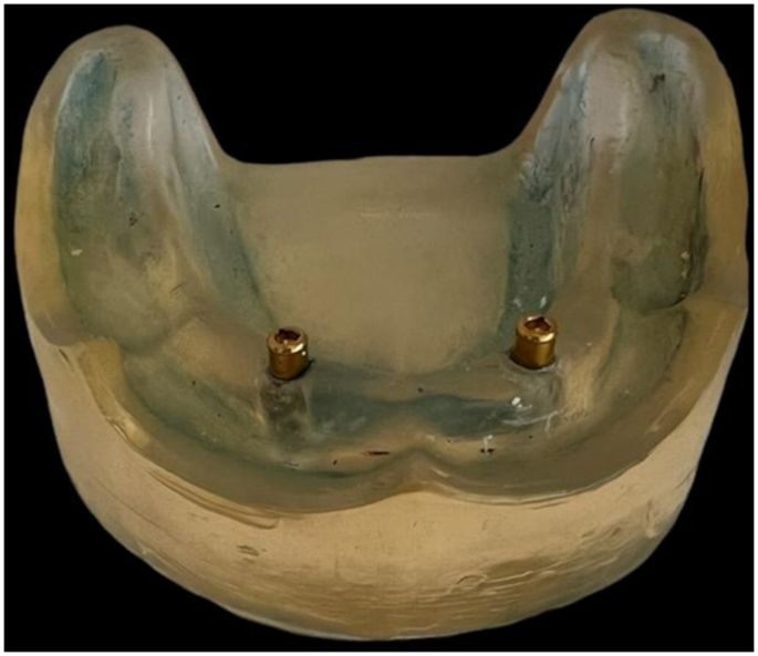 Retention of CAD-CAM locator retentive attachment insert in mandibular ...
