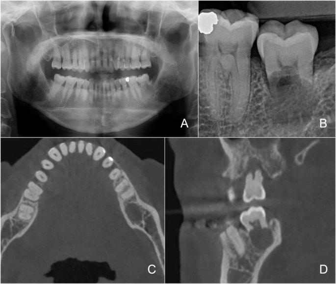 Simple bone cyst with severe root resorption: a case report | BMC Oral Health