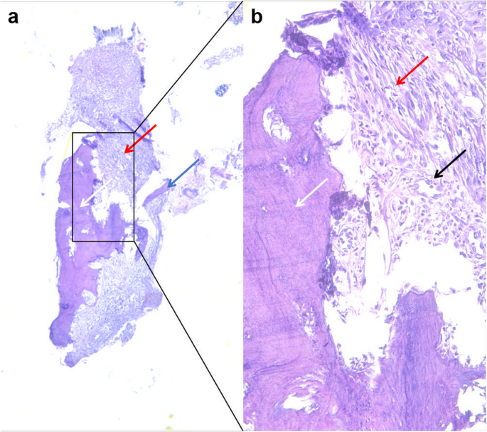Multiquadrant presentation of eruption sequestrum: a case report and ...