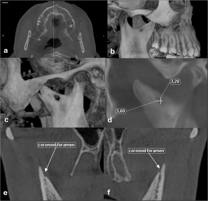 Evaluation of the prevalence and morphometric characteristics of ...
