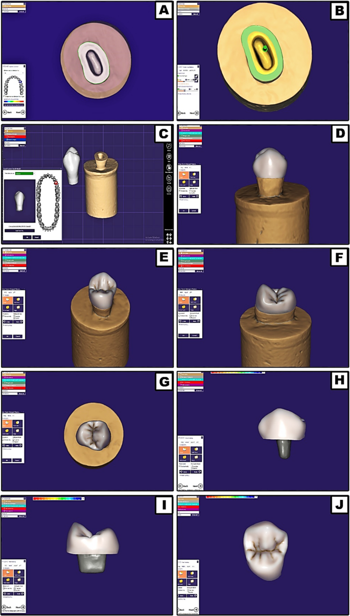 Fracture behavior of endodontically treated premolar teeth restored ...