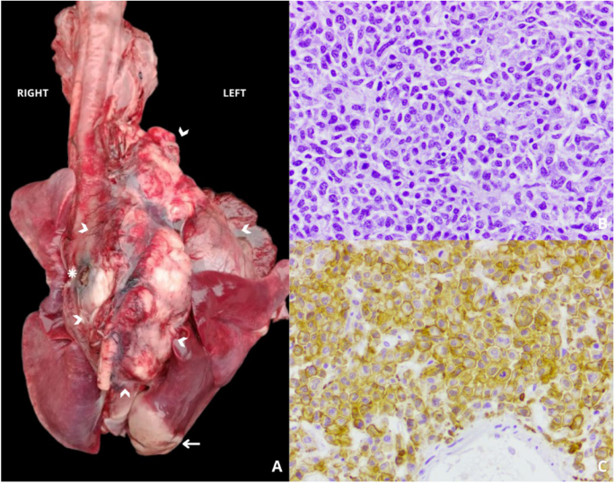 Primary pulmonary histiocytic sarcoma with nodal and esophageal ...