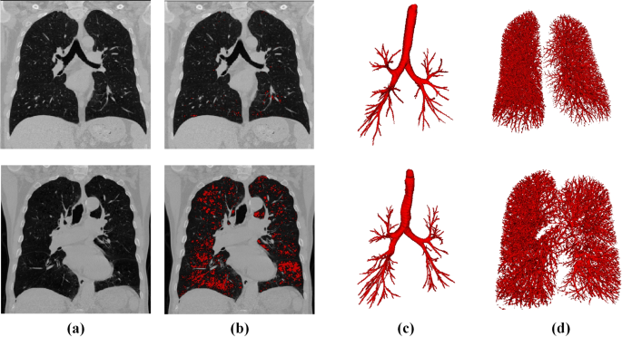 Artificial intelligence in COPD CT images: identification, staging, and ...