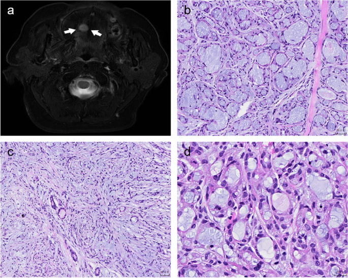 Microsecretory adenocarcinoma of the hard palate: a case report and ...