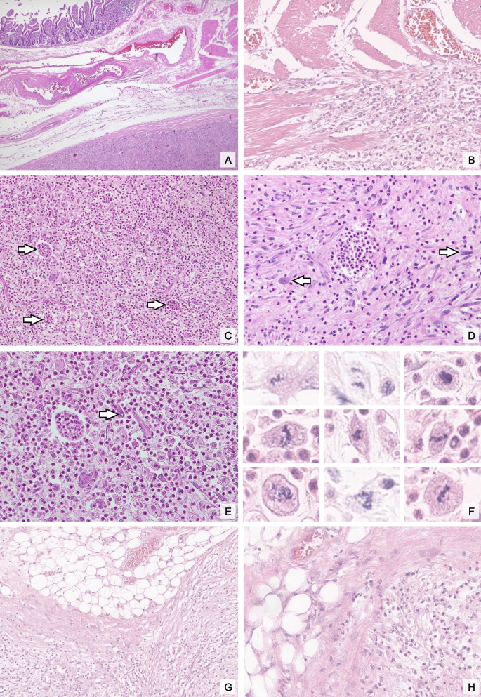 From benign appearance to malignant truth: a case report of mesenteric ...