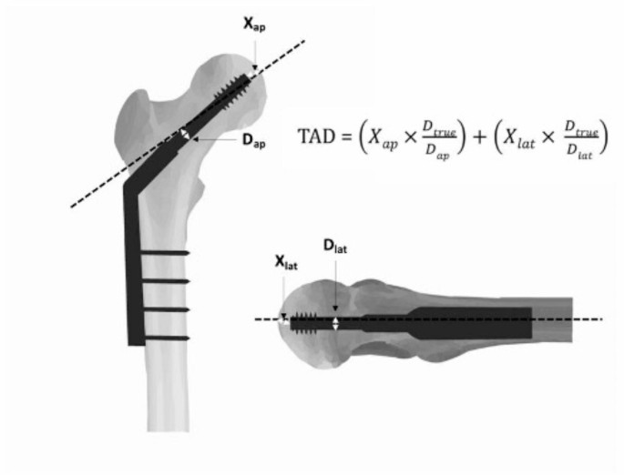 Surgical fixation of hip fractures– a novel technique for pre-operative ...