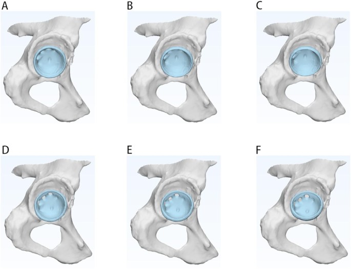 Anatomical landmarks and intraoperative “safe zone” for precise ...