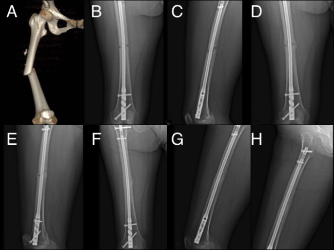 Limited open reduction versus closed reduction in retrograde nailing ...