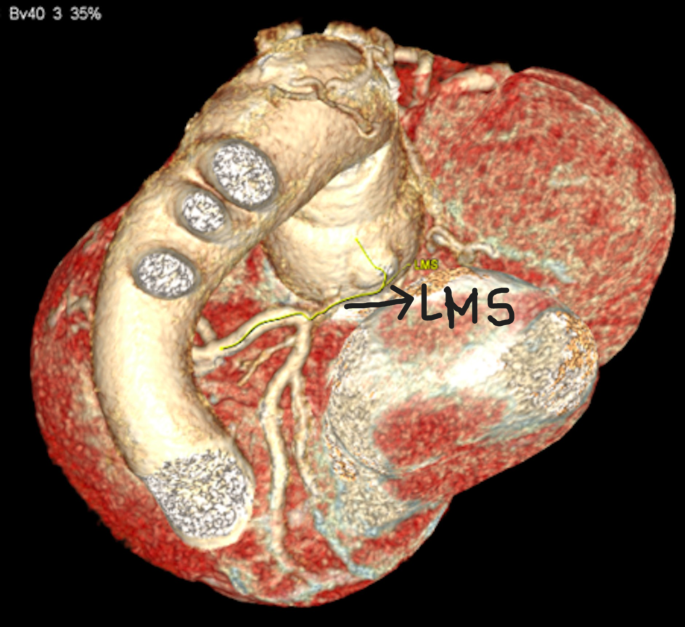 Reoperative minimal invasive off-pump coronary artery bypass graft in ...