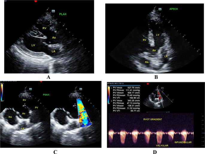 Complete percutaneous repair of Tetralogy of Fallot in adult: a case report | Journal of ...