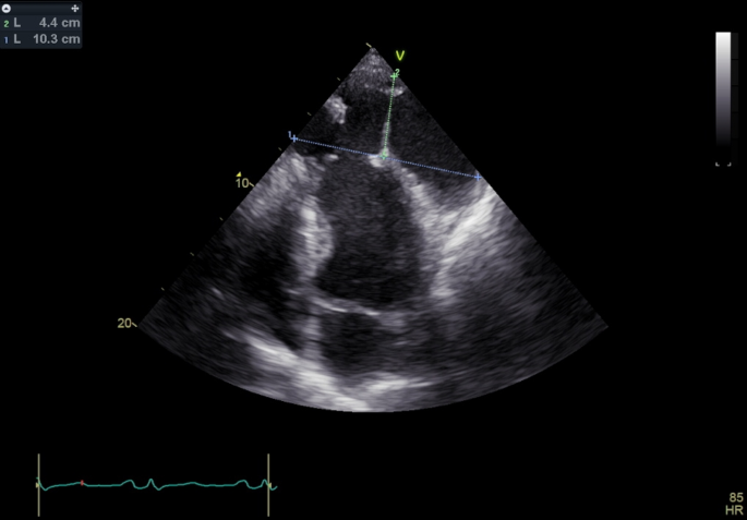 A simplified approach to managing a complex infected left ventricular ...