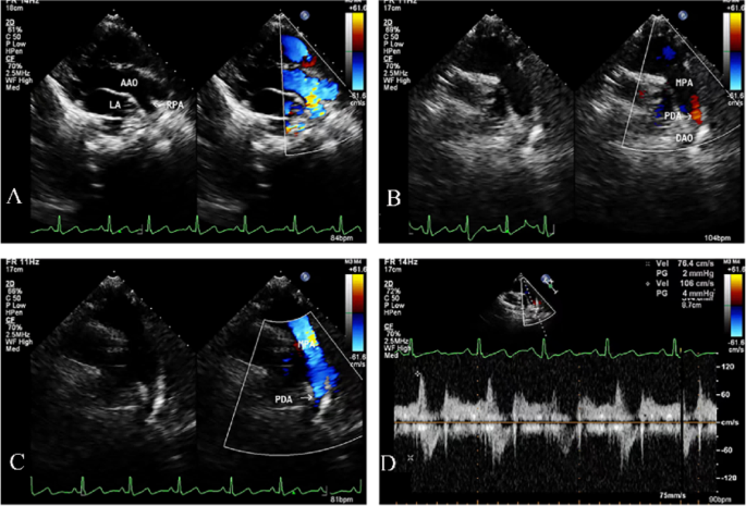 Anomalous origin of a right pulmonary artery identified with ...