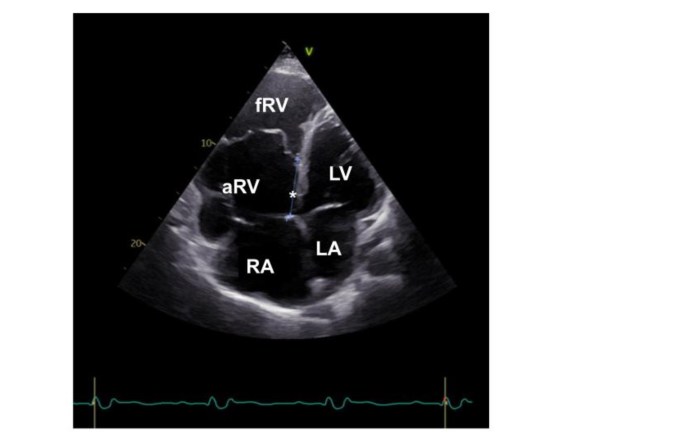 Cone reconstruction after carpentier repair in ebstein anomaly: yes we ...