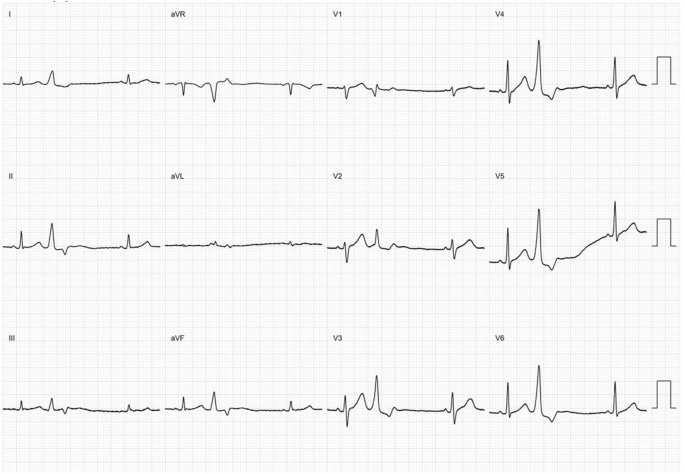 Delayed recurrence of complete atrioventricular block following ...