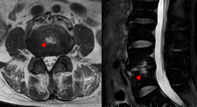A case of Candida parapsilosis endocarditis complicated by right ...