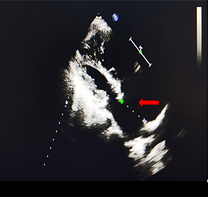 Surgical Management Of A Patient With Mirror Image Dextrocardia With