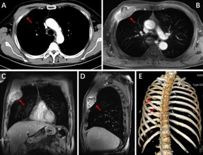 Solitary squamous cell carcinoma of the right chest wall following VATS ...