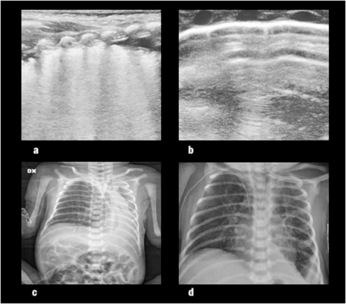 Flow-synchronized nasal intermittent positive pressure ventilation for ...