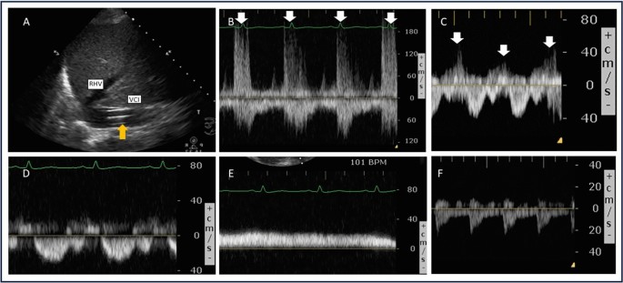 VExUS score in V-V ECMO: the B-wave,Critical Care - X-MOL