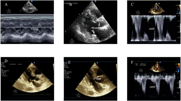 Dynamic left ventricular outflow tract obstruction in critical illness ...
