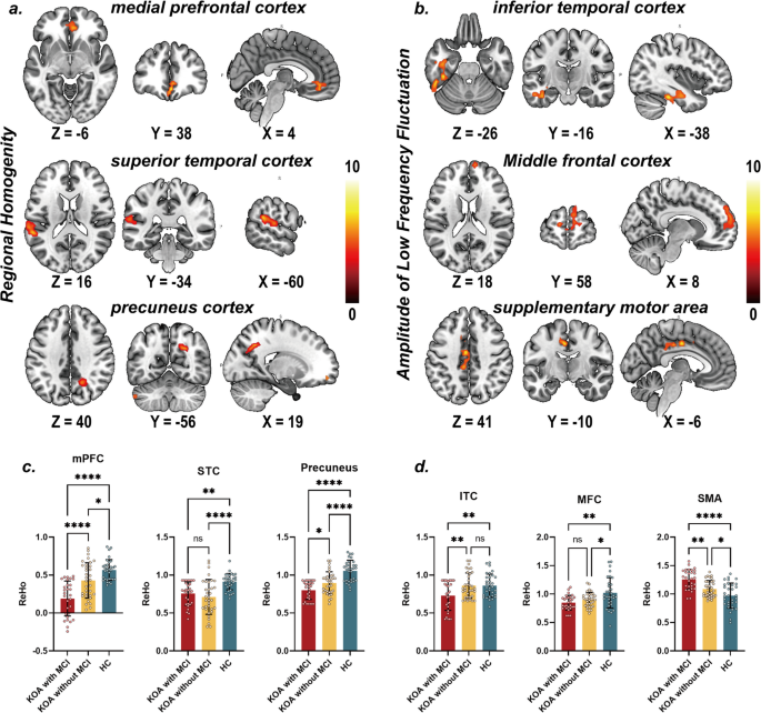 Inflammation-mediated regional brain alterations associated with mild ...