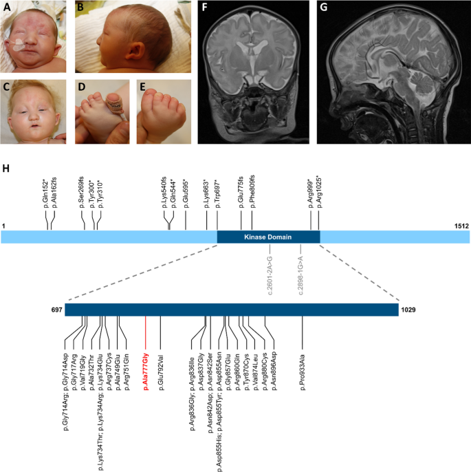 Validation of a hypomorphic variant in CDK13 as the cause of CHDFIDD ...