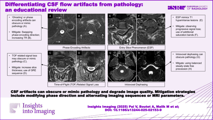 Differentiating CSF flow artifacts from pathology: an educational ...
