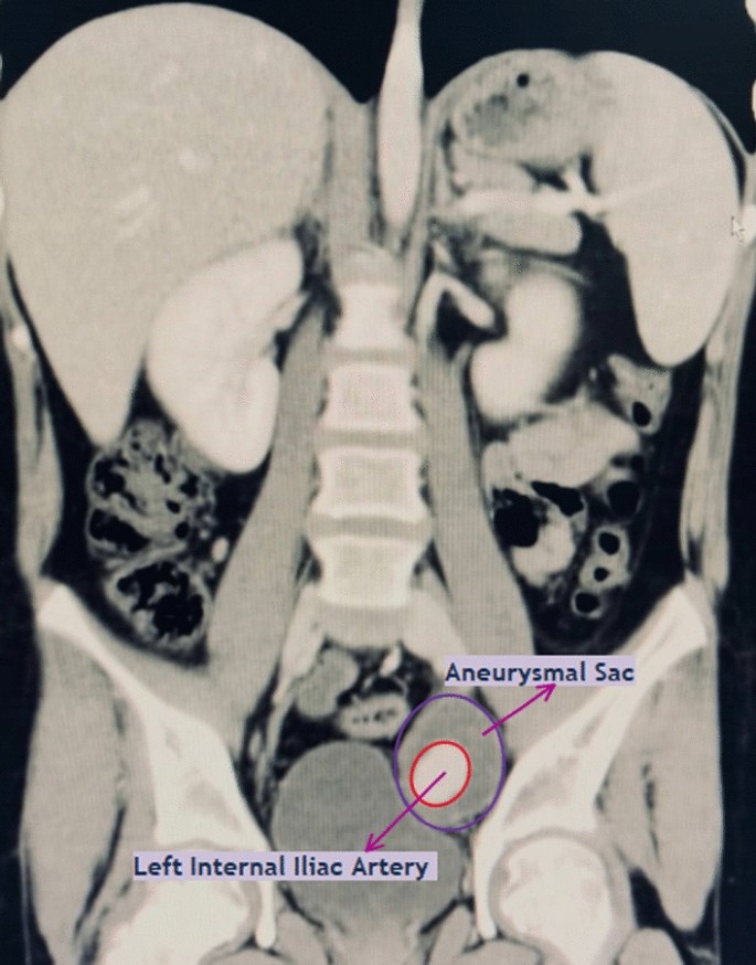An idiopathic left internal iliac artery aneurysm in an 11-year-old boy ...