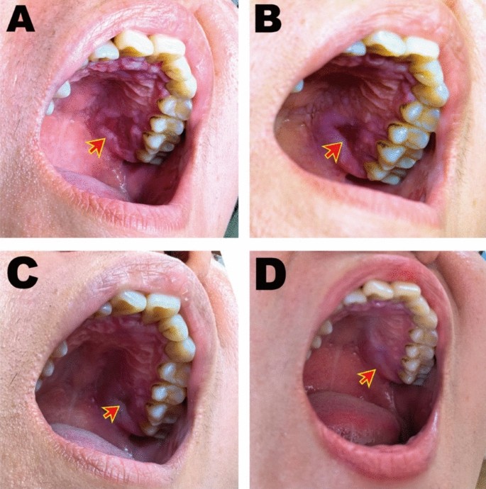Fire needle acupuncture for postherpetic neuralgia of the oral mucosa ...