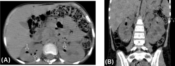 Emphysematous pyelonephritis in a diabetic child: a case report and ...