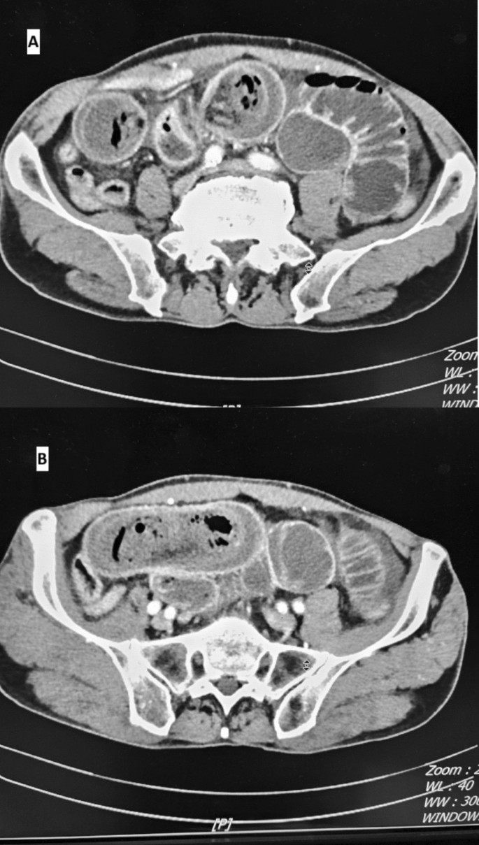 An ileo–ileal idiopathic adult intussusception: diagnostic and ...