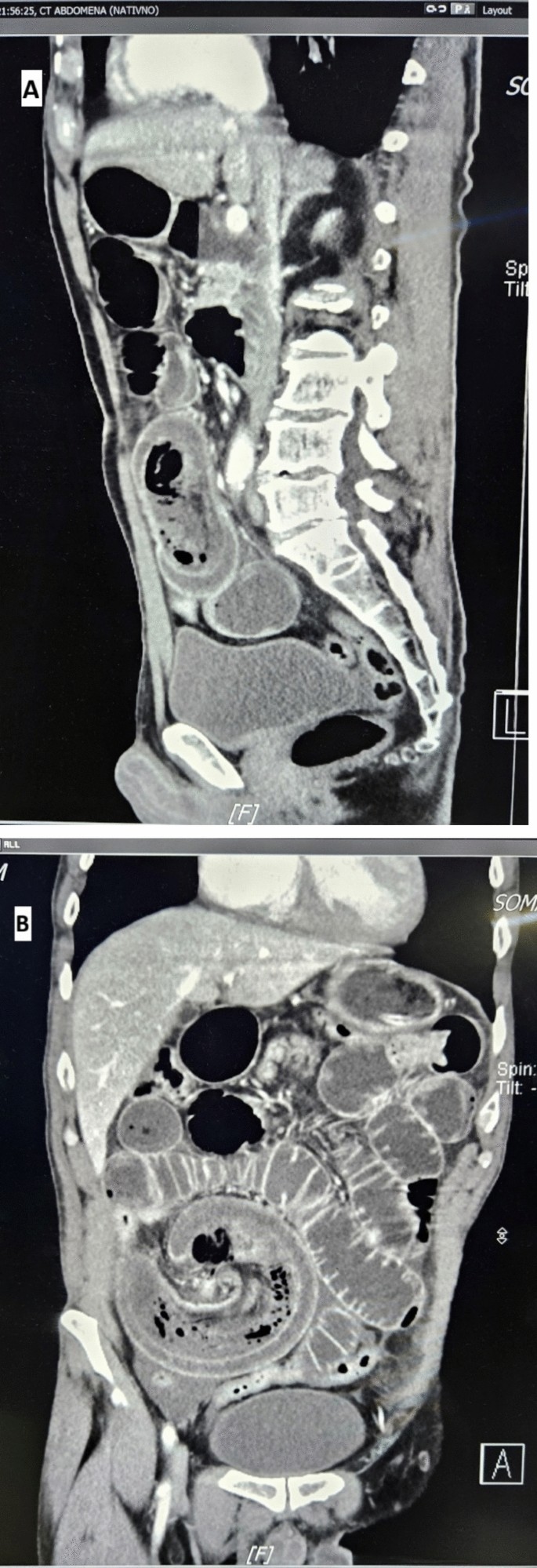 An ileo–ileal idiopathic adult intussusception: diagnostic and ...