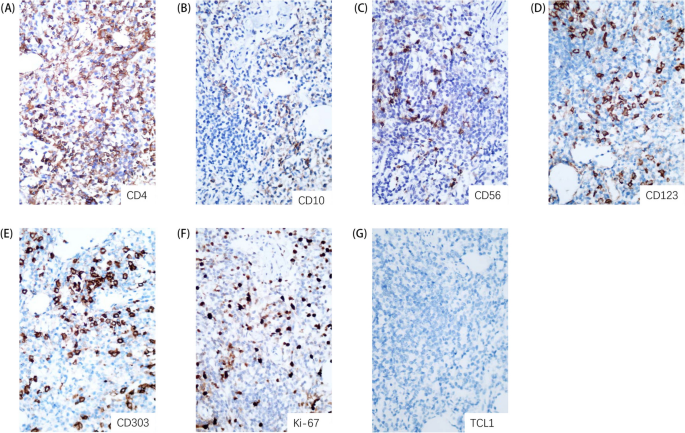 Proliferation of CD10+ mature plasmacytoid dendritic cells in lymph ...