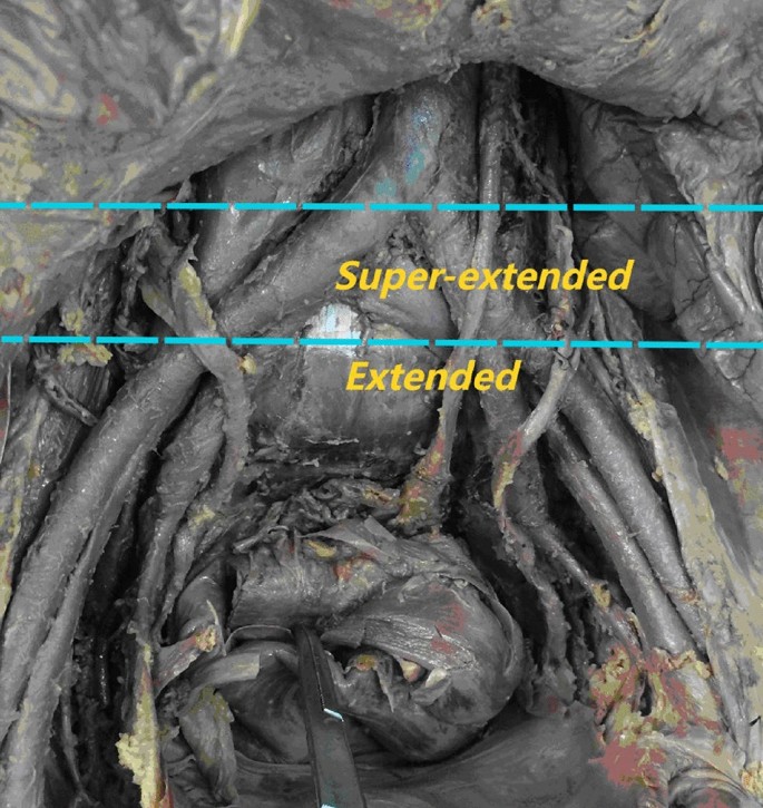 Effects of extended pelvic lymph node dissection on postoperative ...