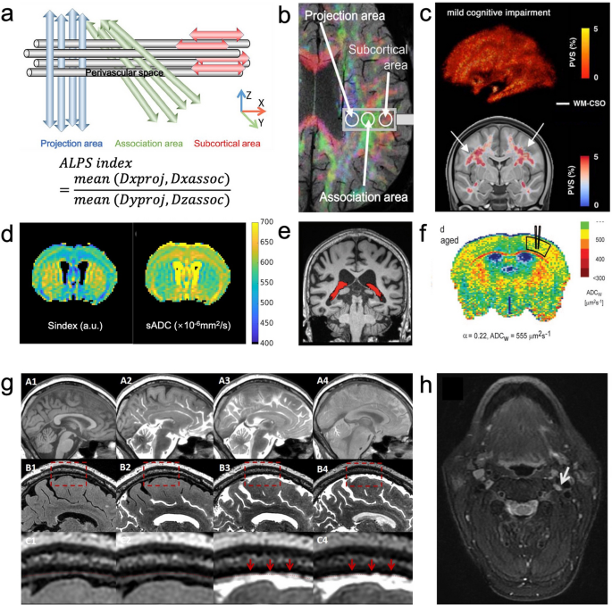 Targeting the glymphatic system: Aβ accumulation and phototherapy ...
