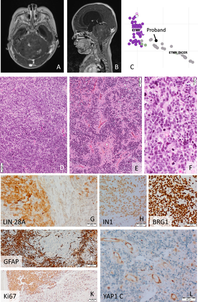 YAP1::MAML2 fusion, a newly identified genetic anomaly in a posterior ...