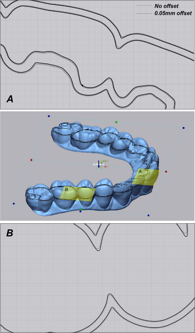 Embrasure aligner fit and thickness in 3D-printed and thermoformed ...