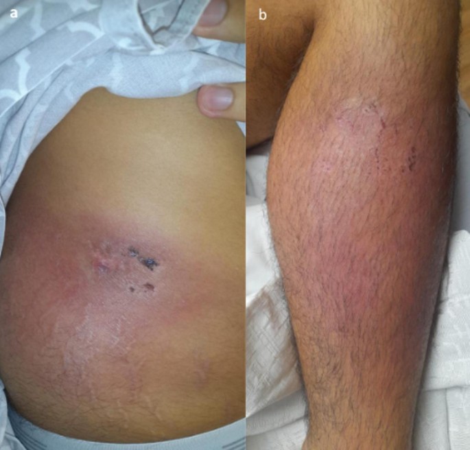 Atypical presentation of Lyme disease in a returning traveler: a case ...