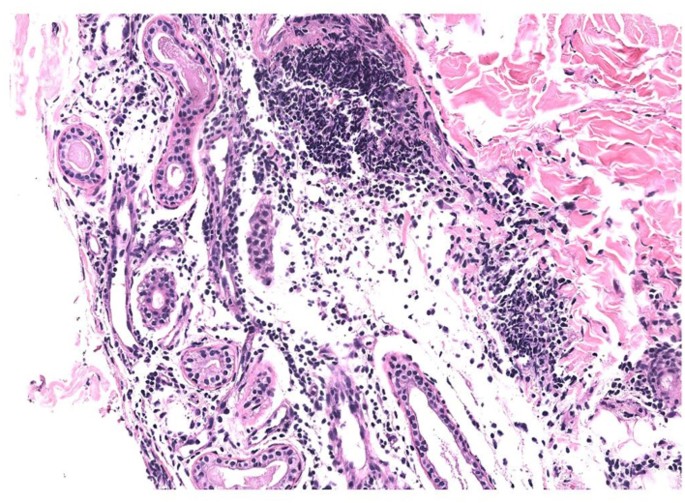 Atypical presentation of Lyme disease in a returning traveler: a case ...