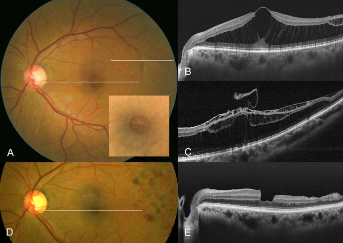 Pars plana vitrectomy in progressive severe stellate non-hereditary ...
