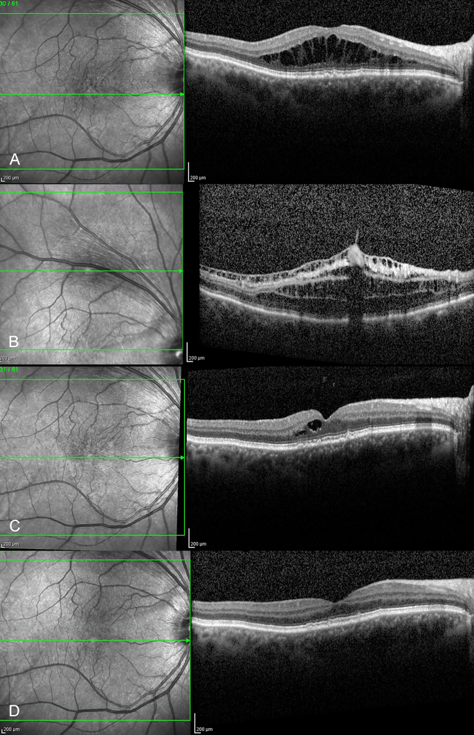 Pars plana vitrectomy in progressive severe stellate non-hereditary ...