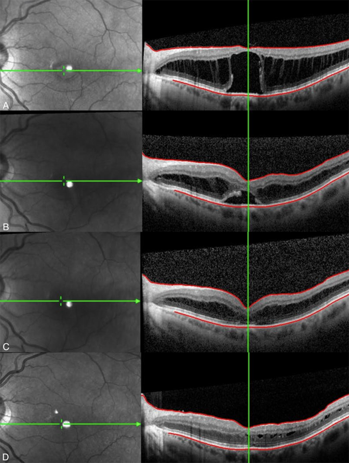 Pars plana vitrectomy in progressive severe stellate non-hereditary ...