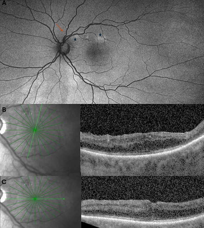 Methylene blue associated retinal toxicity | International Journal of ...