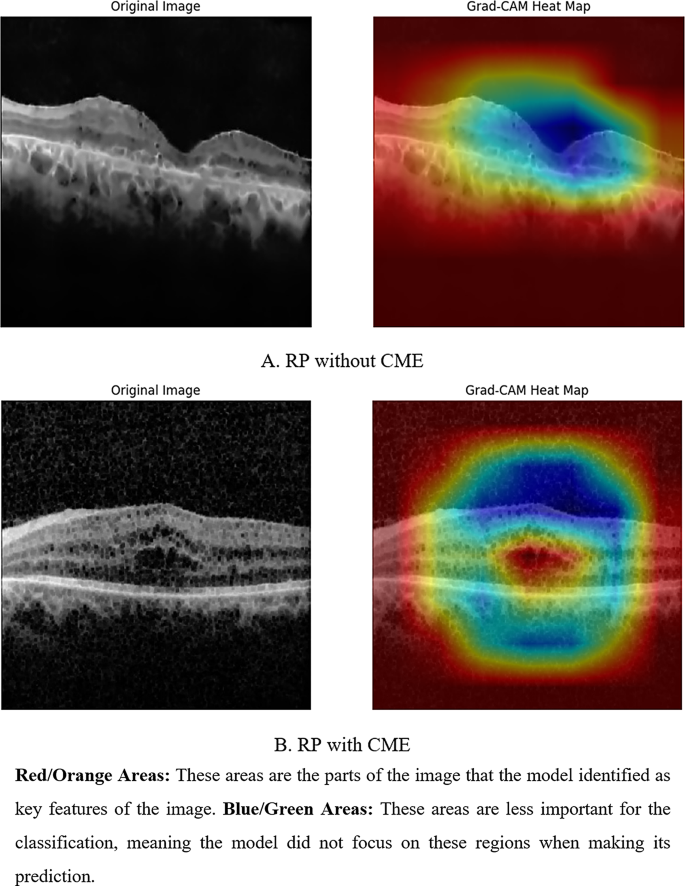 Detection of cystoid macular edema in patients with retinitis ...