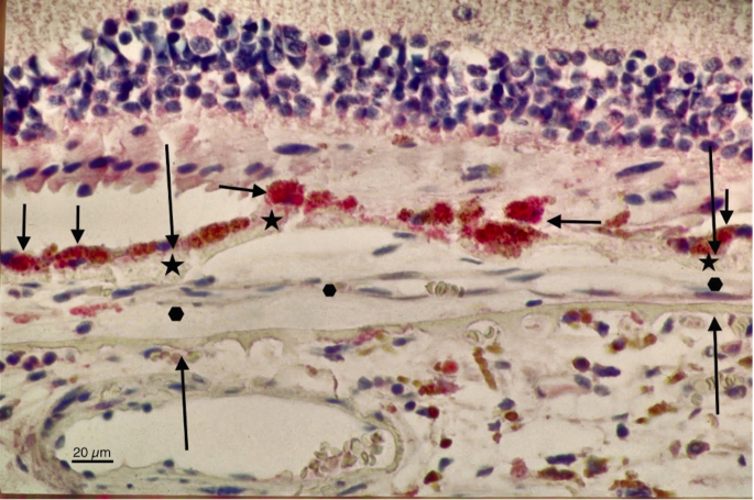 Histopathologic evidence of VEGF in early neovascular AMD: from a 1992 ...