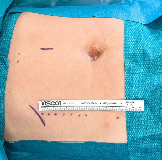 Open donor nephrectomy via singular pararectal extraperitoneal mini ...