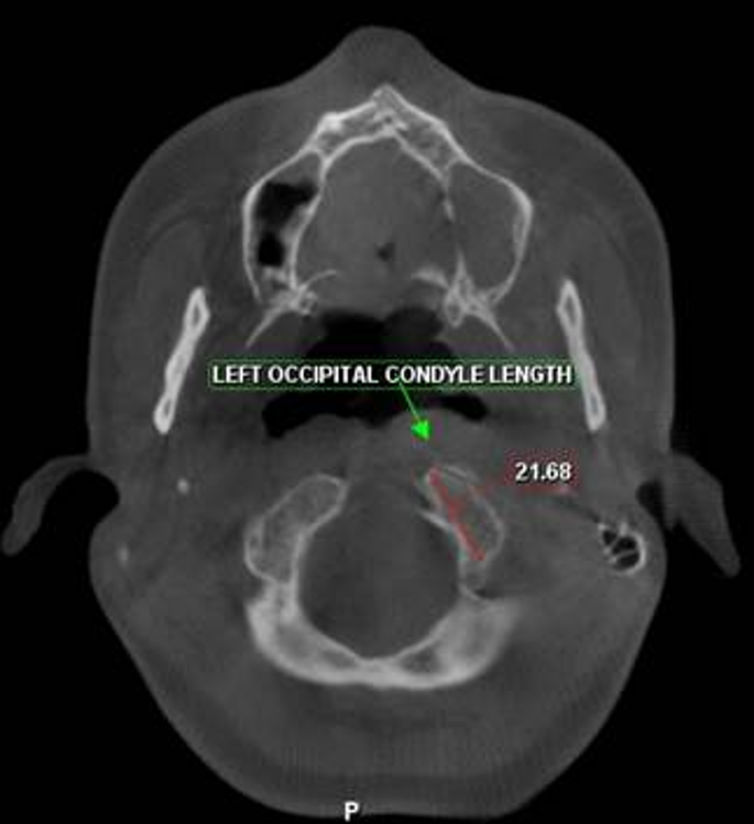 Occipital condyle measurements for age and sex estimation: a ...