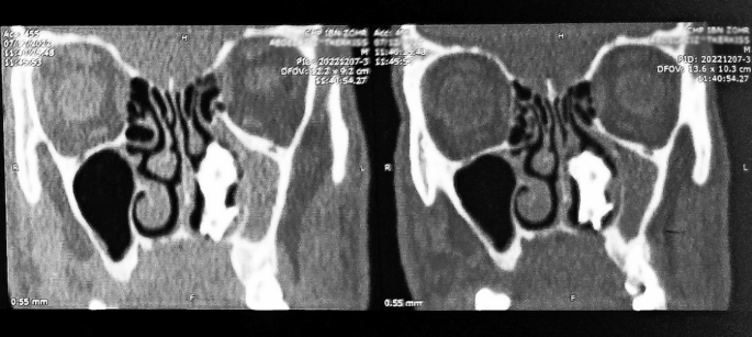 Giant rhinolithiasis formed around a huge neglected nasal piece of ...